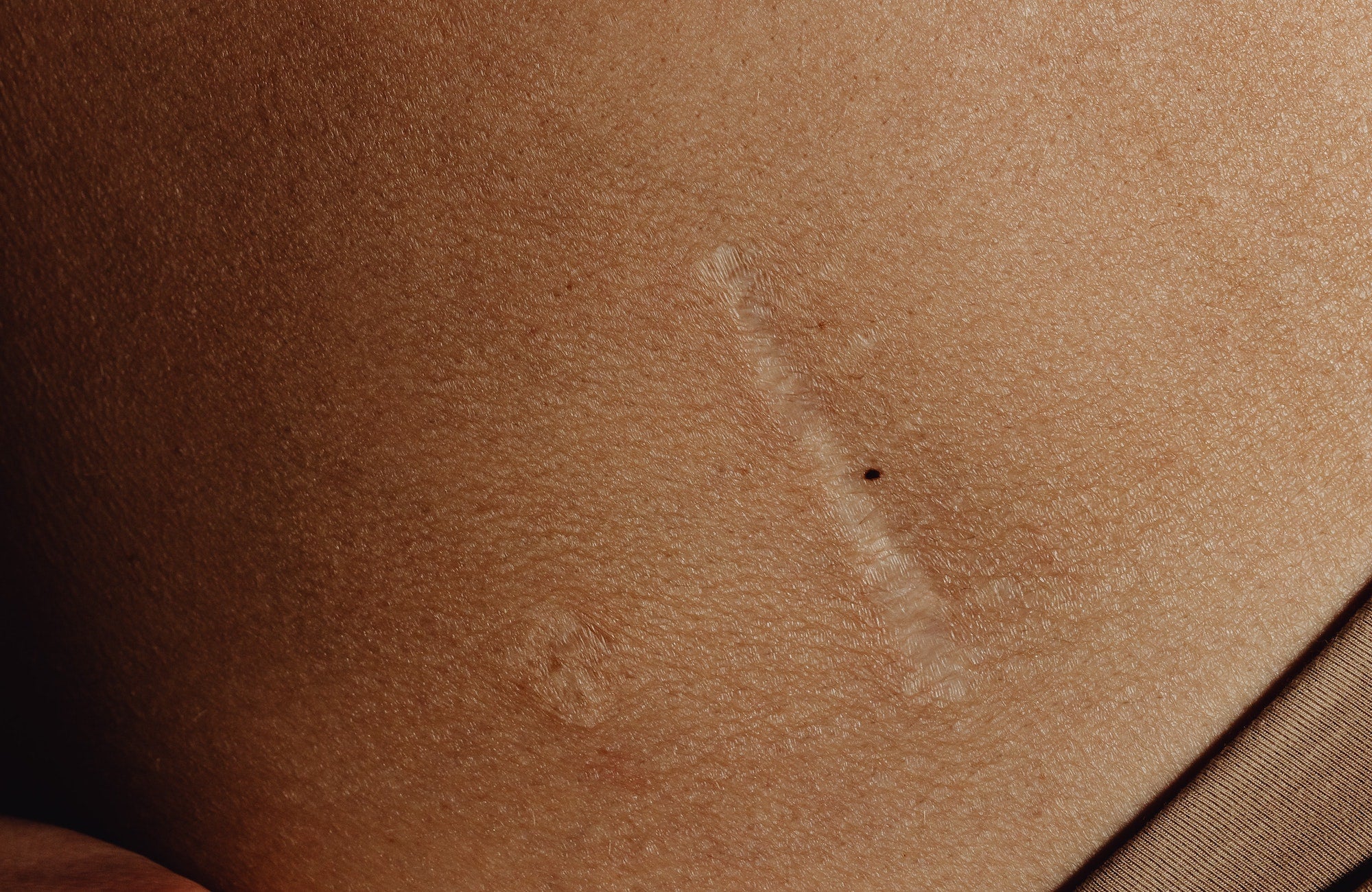 How to Get Rid of Scars Permanently — Leading Medical Solutions 2023 ...